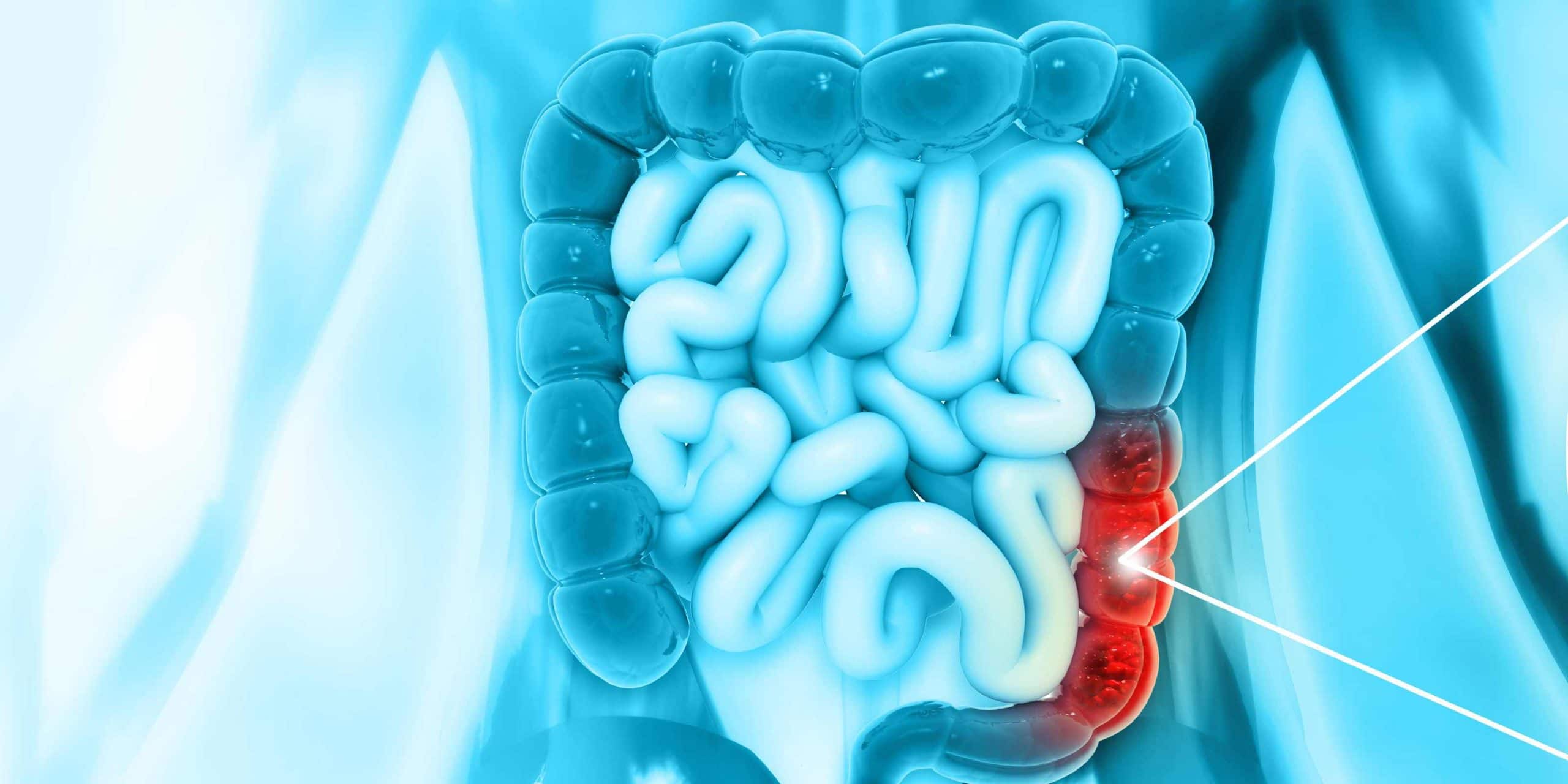 Colon Irritable – Claire Borwin – Diététicienne Nutritionniste Sartrouville